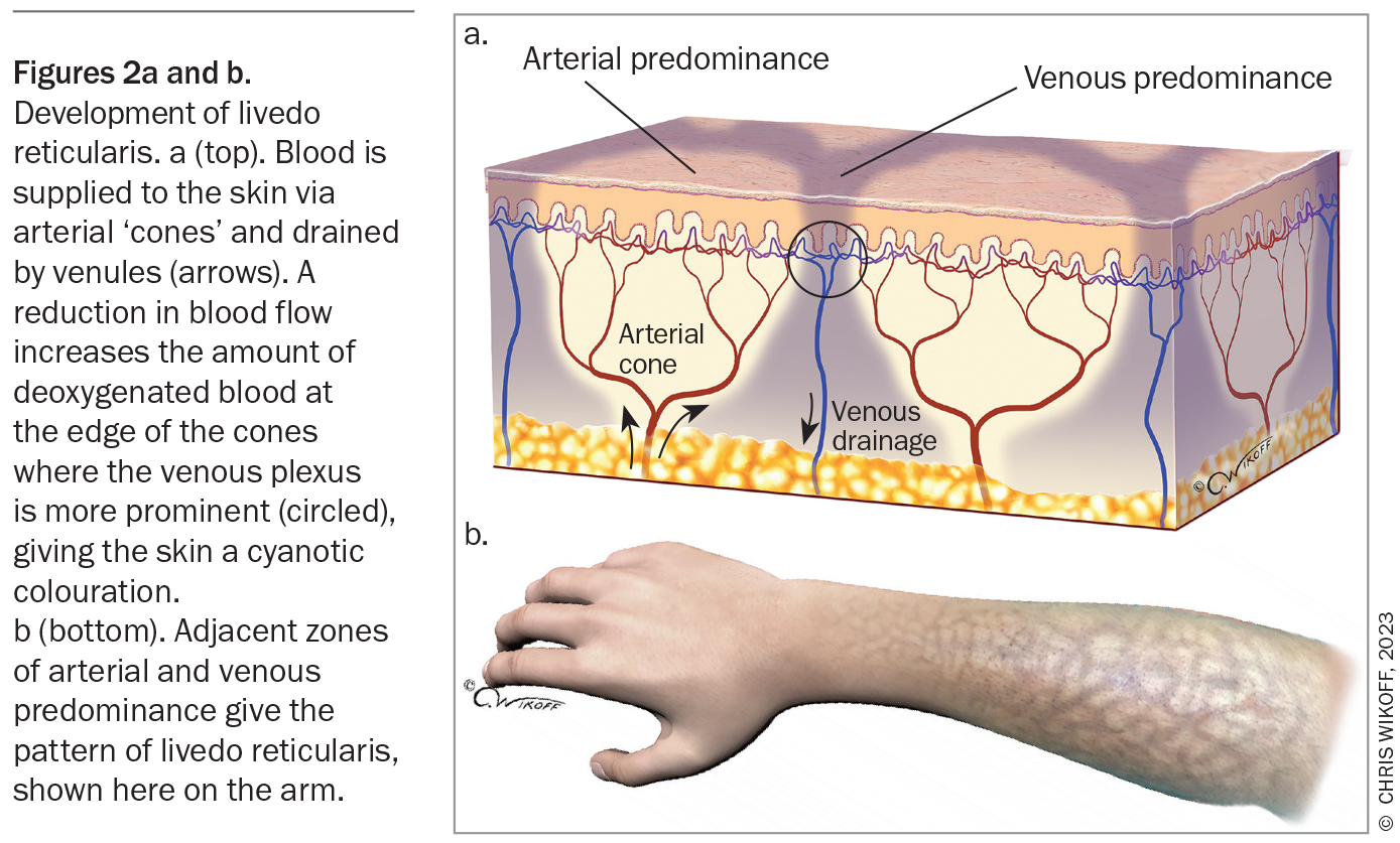 Reticulated hyperpigmentation and erythema on the legs | Medicine Today